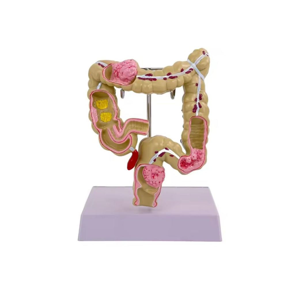 Pathological Large Intestine Model – MedStore